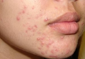 Jerawat: Punca, Rawatan, dan Cara Mencegah jerawat. - Dr Kulit